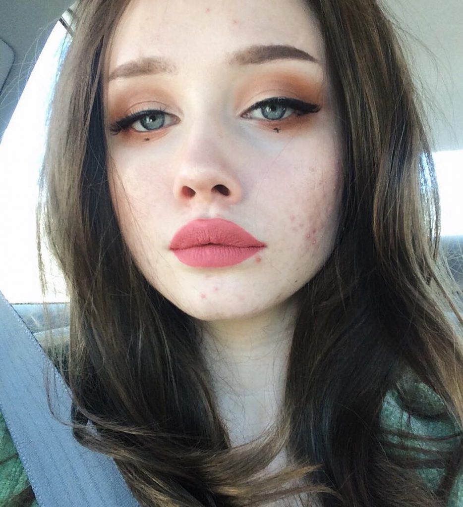 มีสิวแต่สวย !! "Hailey Wait" ผู้สร้างแรงบันดาลใจให้กับคนเป็น 'สิว' ใน ...