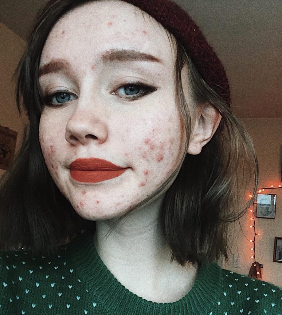 มีสิวแต่สวย !! "Hailey Wait" ผู้สร้างแรงบันดาลใจให้กับคนเป็น 'สิว' ใน ...